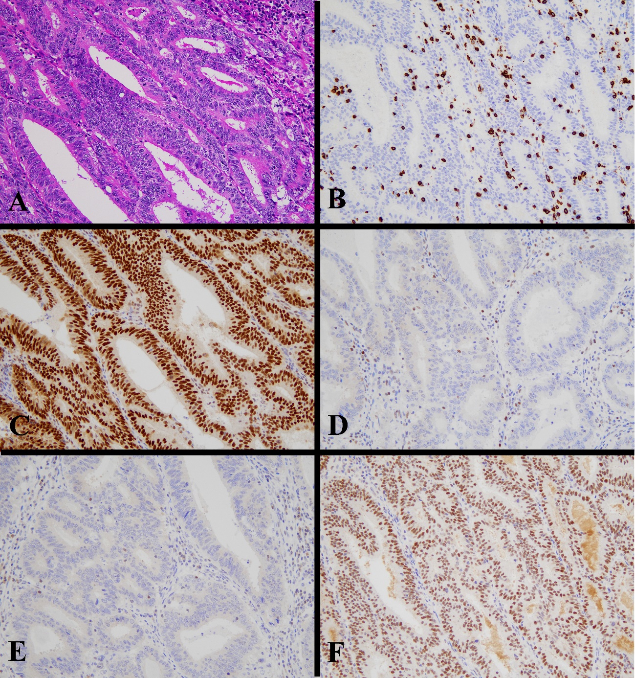 CD8, MMR, p53 in endometrial carcinoma | Encyclopedia MDPI