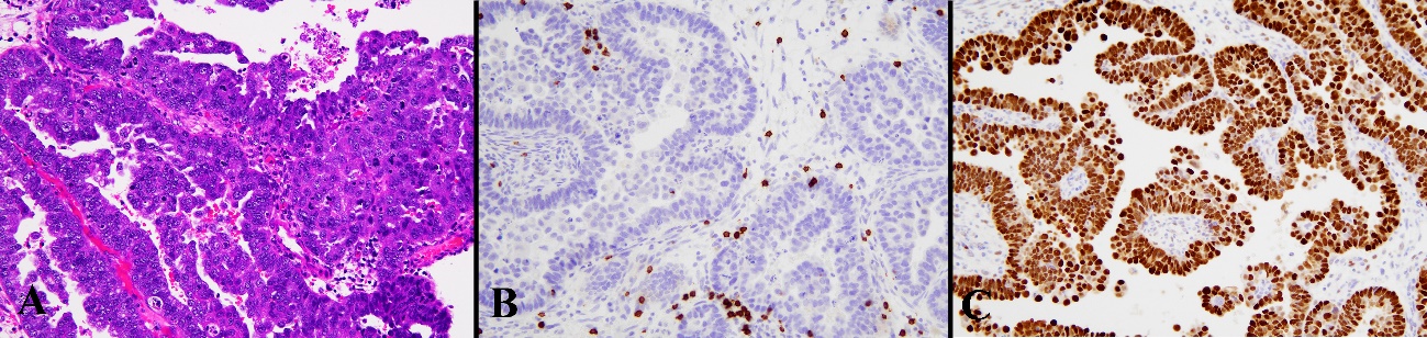 CD8, MMR, p53 in endometrial carcinoma | Encyclopedia MDPI