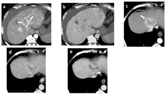 Imaging Diagnosis of Hepatocellular Carcinoma | Encyclopedia MDPI