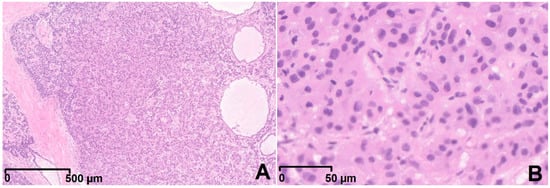 Pancreatic Acinar Cell Carcinoma | Encyclopedia MDPI