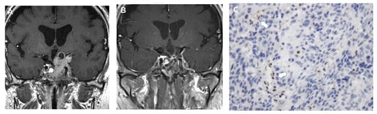 Epidemiology, Pathogenesis and Diagnosis of Prolactinoma | Encyclopedia ...