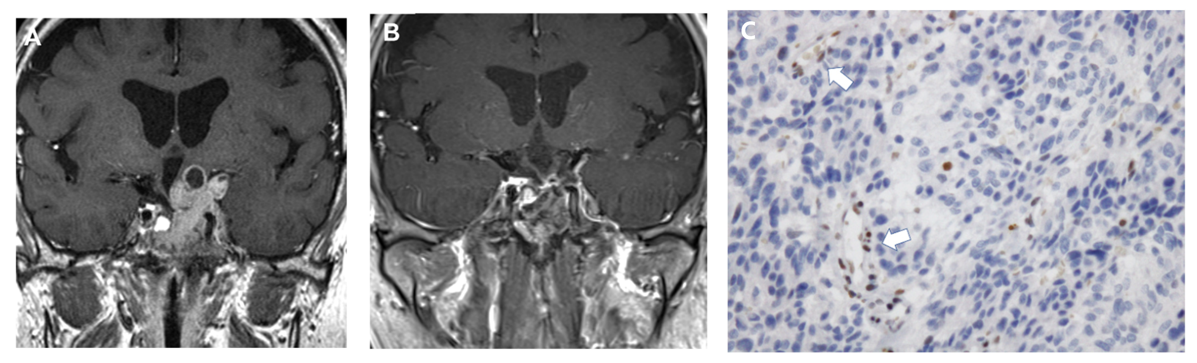 Epidemiology, Pathogenesis and Diagnosis of Prolactinoma | Encyclopedia ...