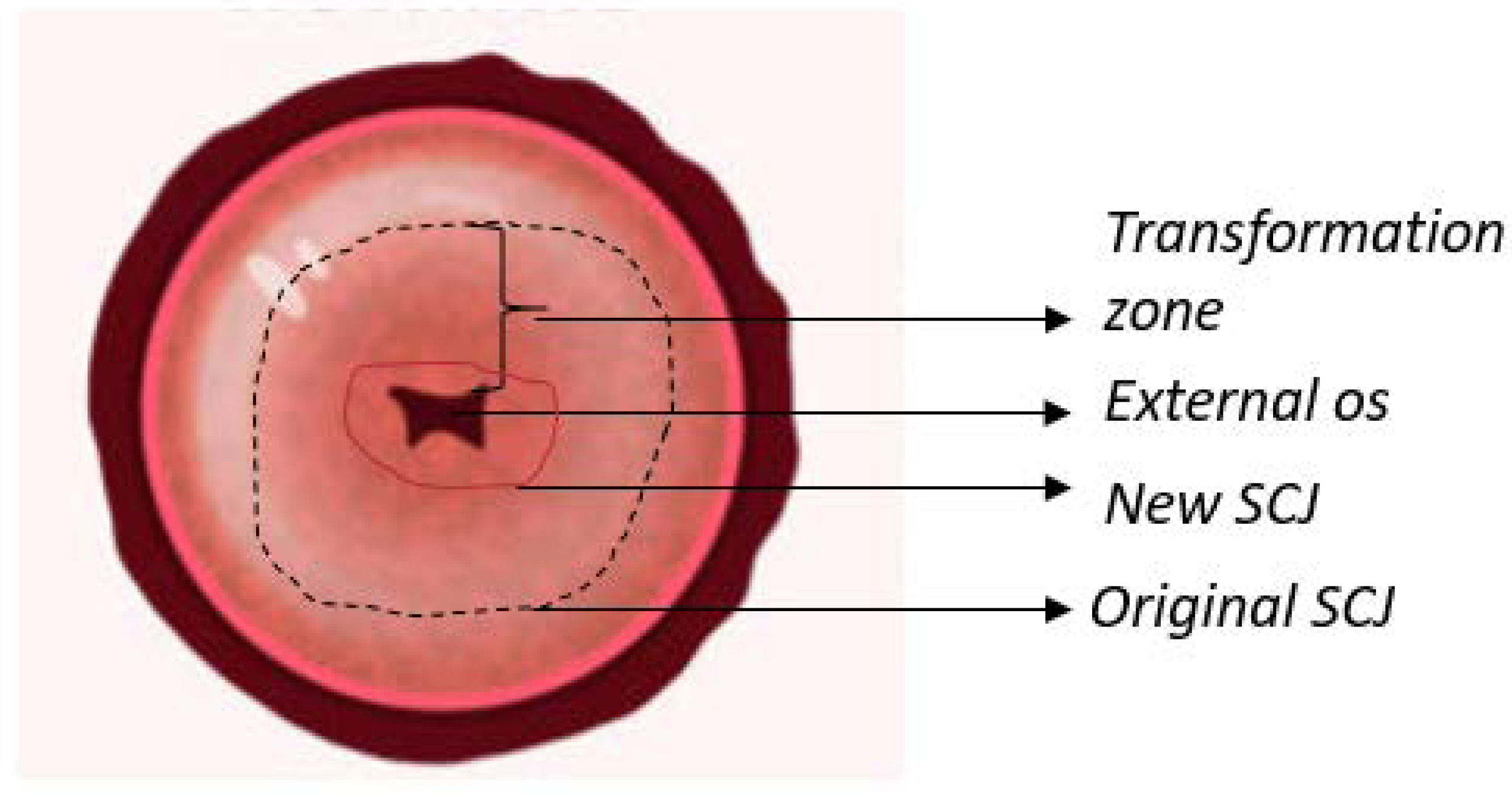 Cervical Imaging In The Low Resource Setting Encyclopedia MDPI Cervical Imaging In The Low Resource Setting Encyclopedia MDPI